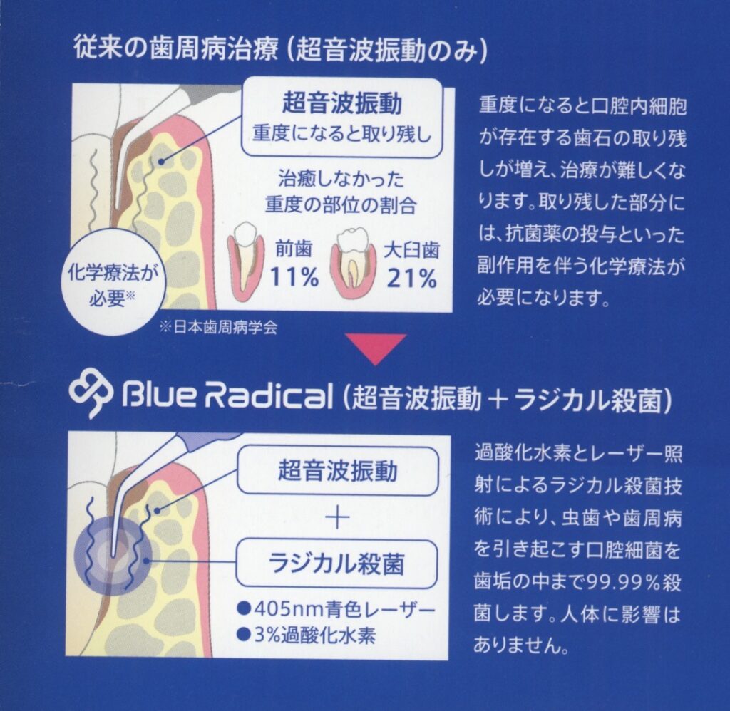 ブルーラジカル入荷しました - 梅田北新地の歯医者かわさと歯科・矯正歯科 歯周病・セラミック